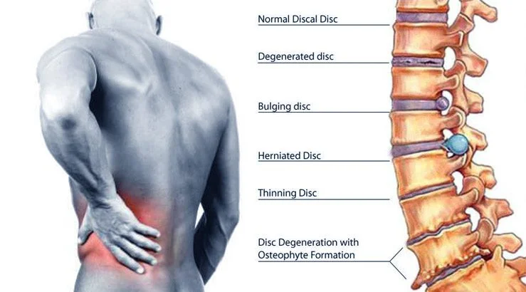 Slipped Disc Treatment in KL: Which Method Works Best - Netnox Solutions